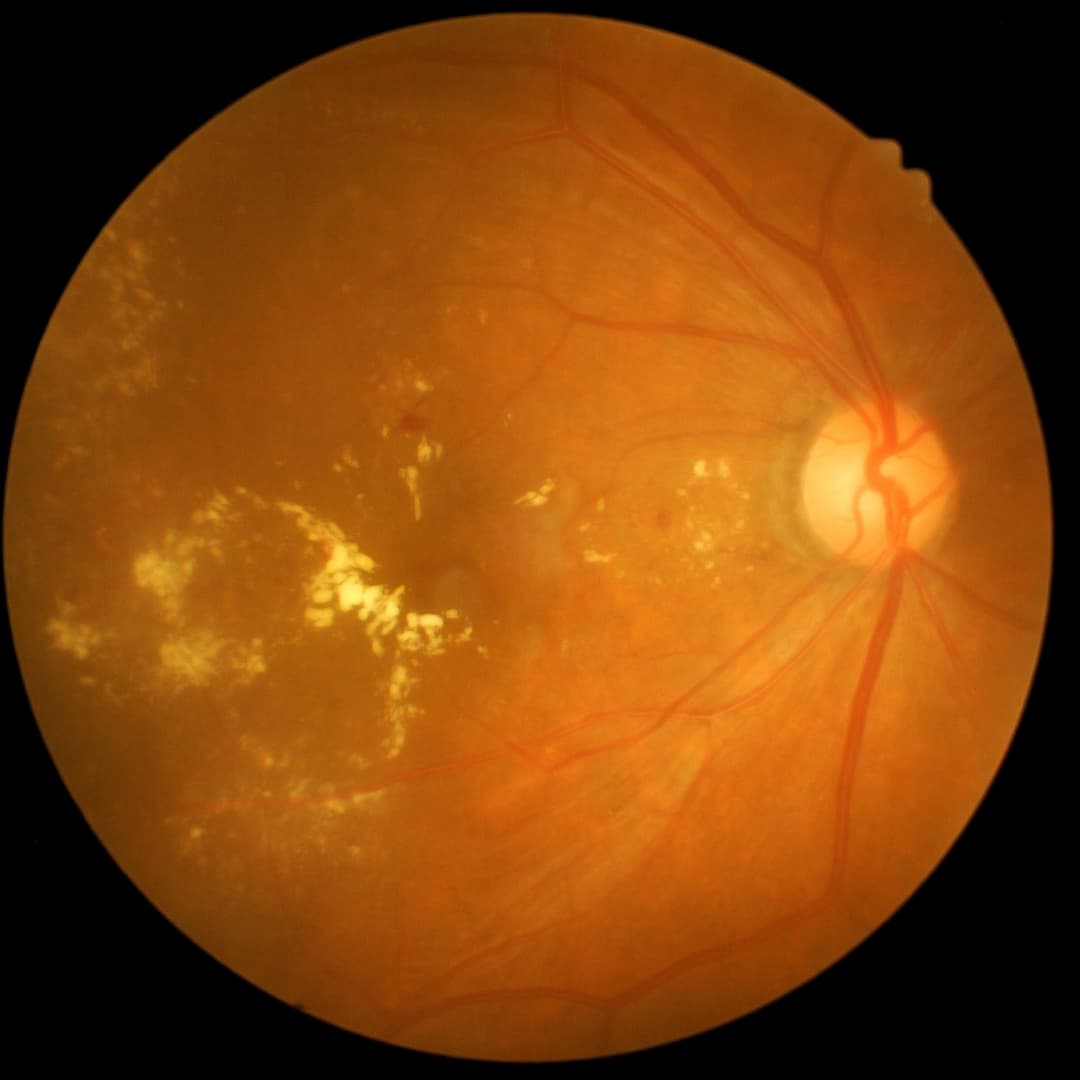 Diabetic Retinopathy - Causes, Signs, And Treatment. - Chadderton Opticians